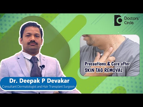 SKIN CARE After LASER SKIN TAG REMOVAL | Radiofrequency Laser - Dr. Deepak P Devakar|Doctors' Circle