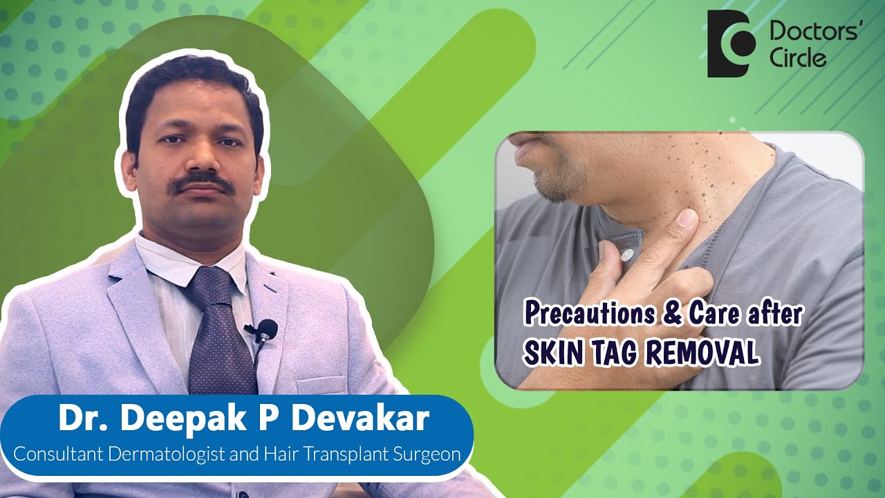 SKIN CARE After LASER SKIN TAG REMOVAL | Radiofrequency Laser - Dr ...