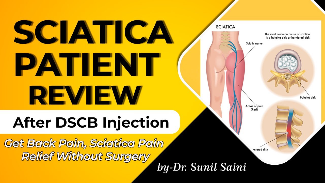 Sciatica Pain Relief Patient Real Testimonial after DSCB Injection ...