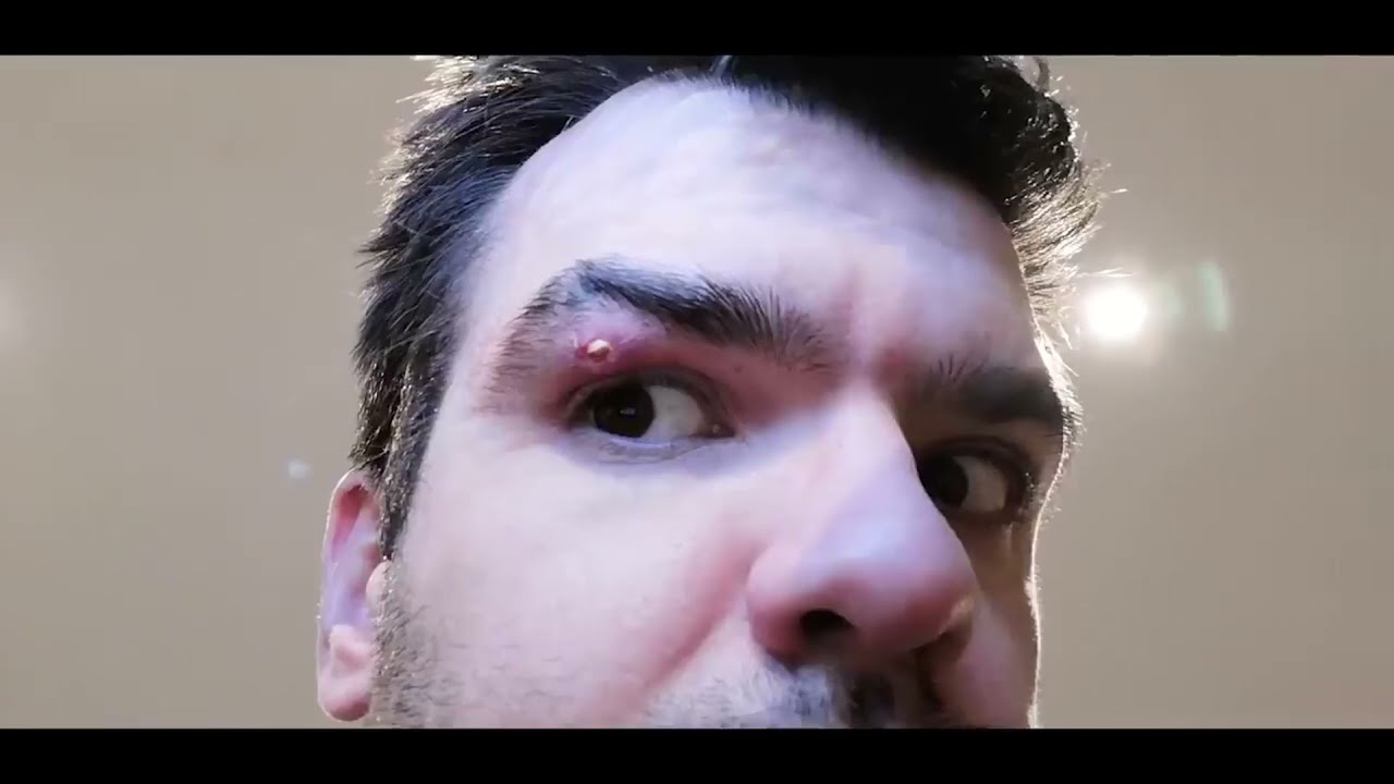 Most Satisfying Pimple Popping Moments 2021!! - YouTube