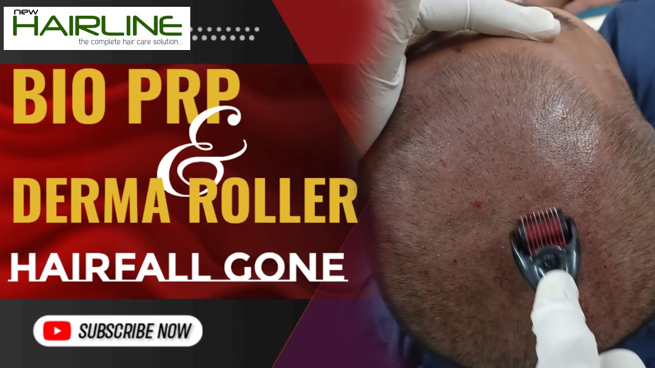 BIO PRP with Dermaroller | Hairfall Solution | Best Hair Transplant ...