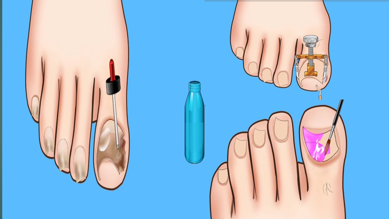 ASMR Toe Nail Removal: Gentle Animation for Relaxation and Comfort ...