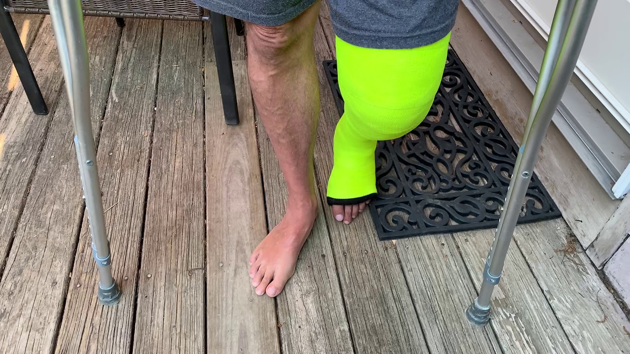 Broken leg - YouTube