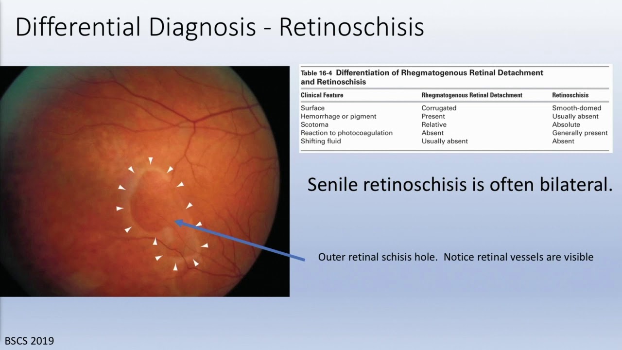 Retinal Detachment - YouTube