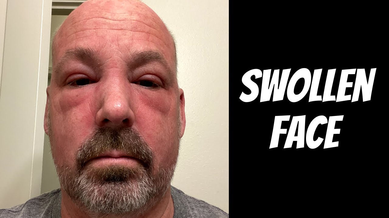 Swollen Face - Cancer Update - YouTube