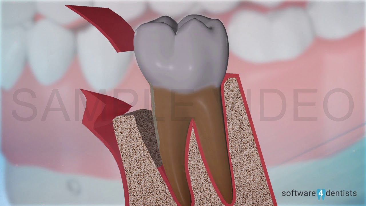 Perio bone grafting - YouTube