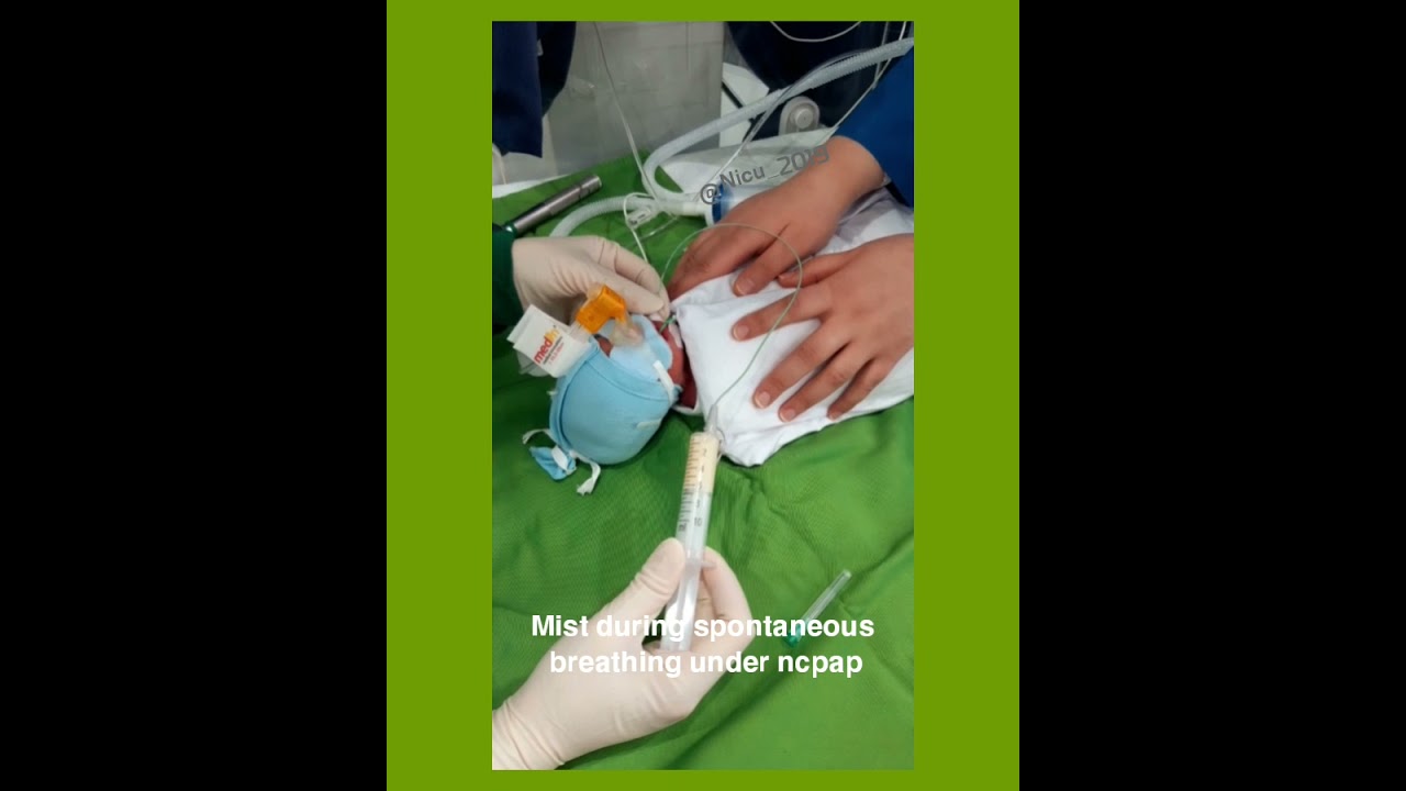 Surfactant therapy (MIST) - YouTube