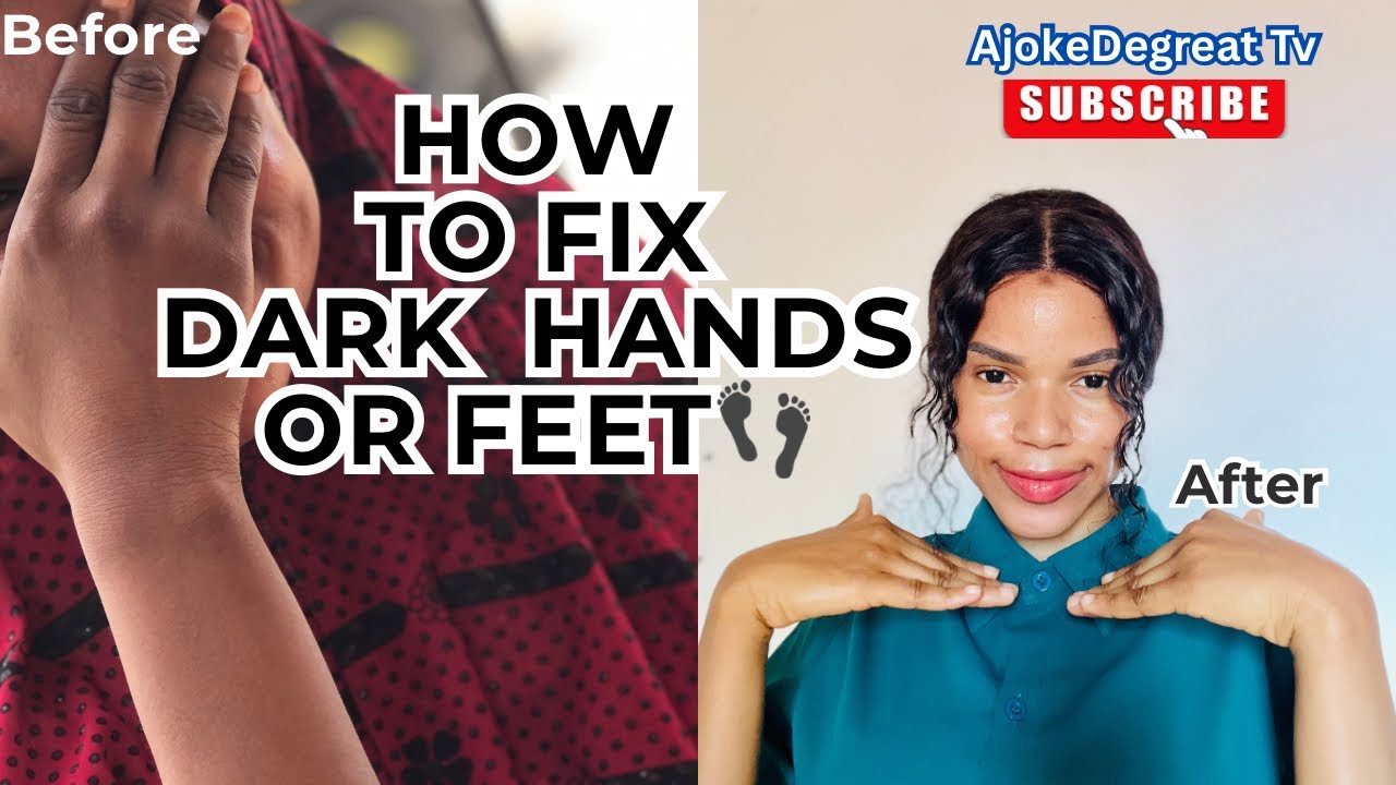 Skin Series Ep 5: Dark Hands & Feet? Fix Hyperpigmentation (Before ...