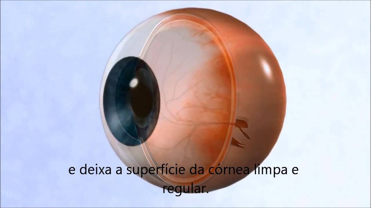 O que é o edema da córnea e como aliviar os seus sintomas - YouTube