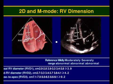 assessment of the right ventricle by echocardiography - YouTube
