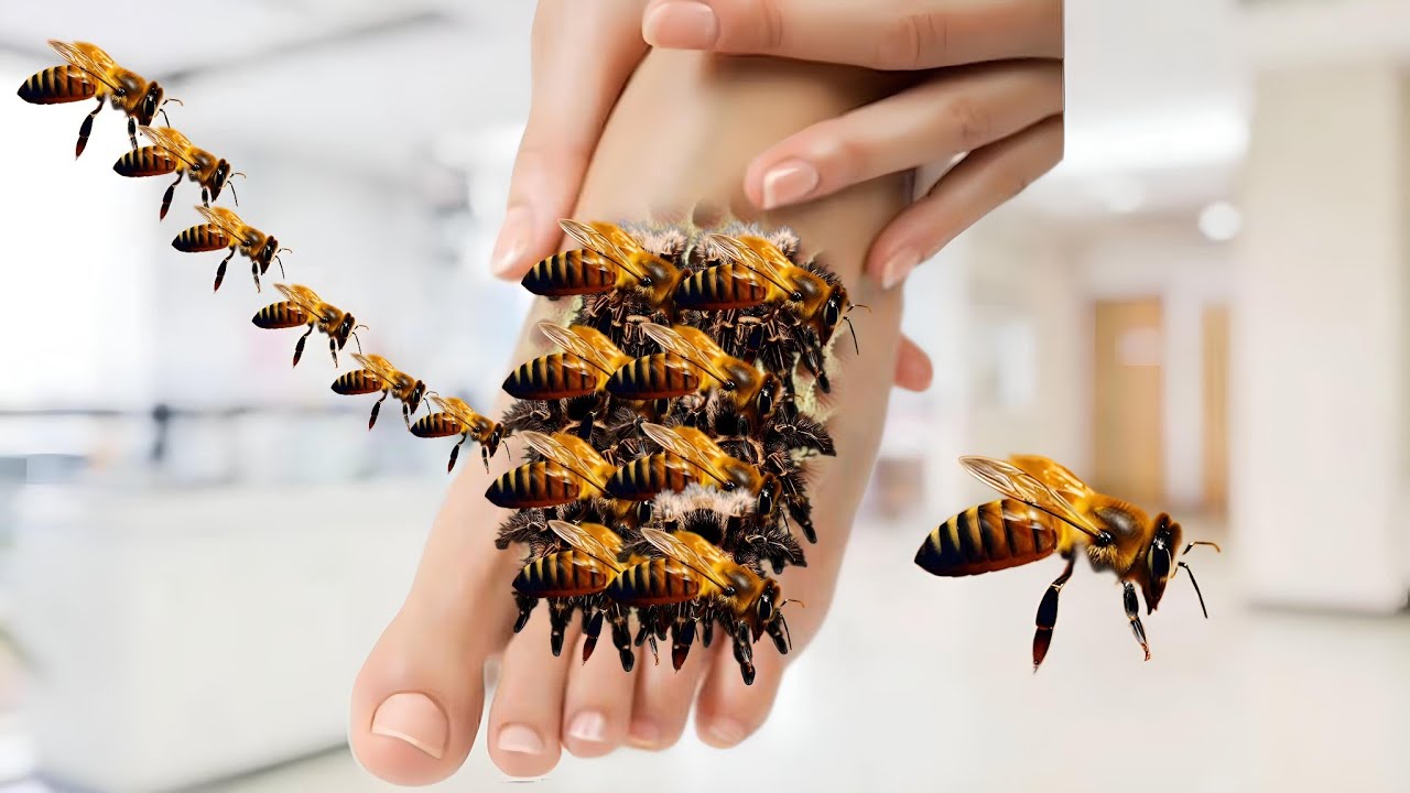 Asmr urgent surgery from infacted #bee from leg 🦵 | 2d animation deep ...