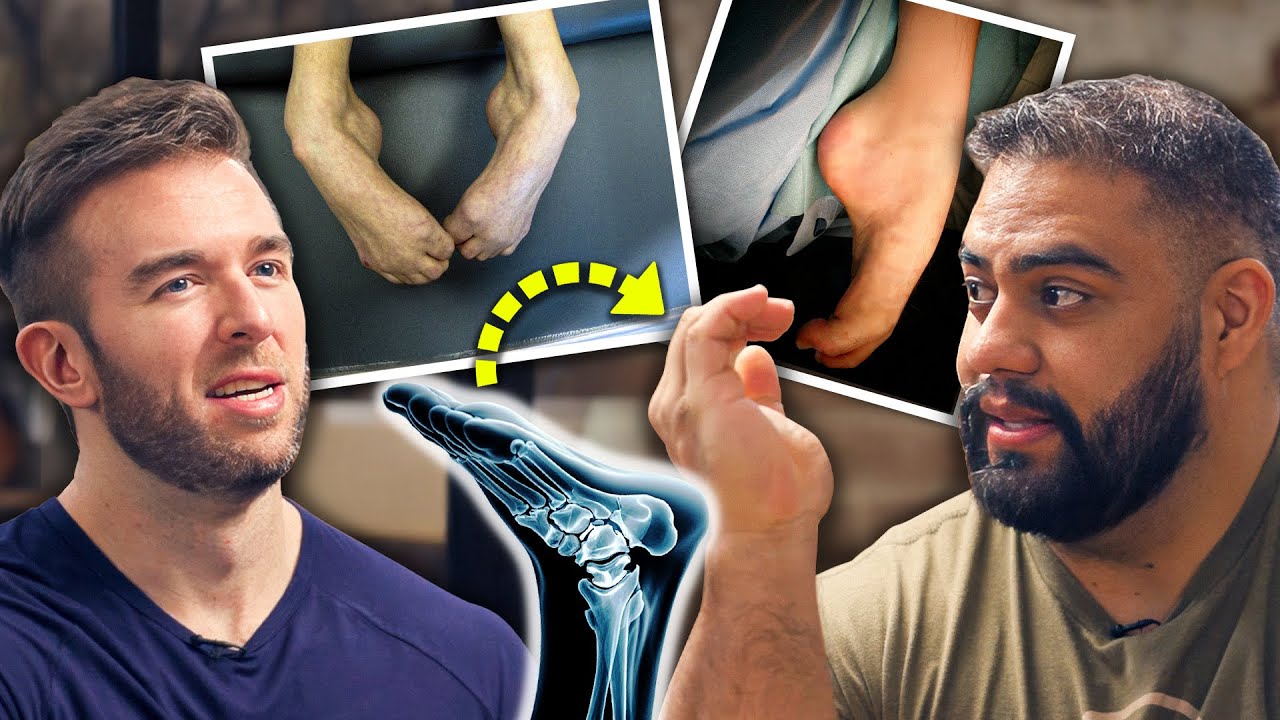 Crippling ‘Ballerina Feet’ Claw Syndrome From Limb Lengthening Surgery ...