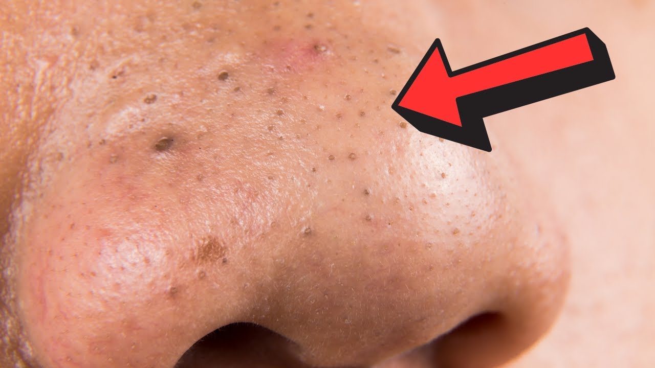 La Mejor ELIMINACIÓN de ESPINILLAS y PUNTOS NEGROS #ACNE 2023 ...