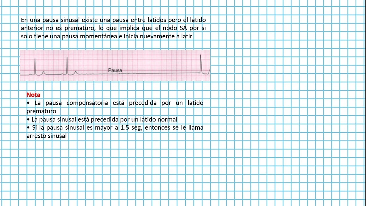 Bloqueo del NODO SA (Clases EKG #36) - YouTube