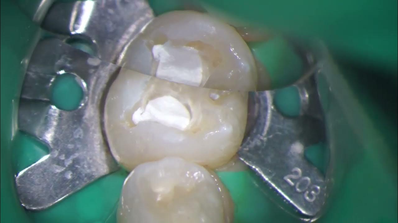 Indirect pulp capping with MTA(CSC) - YouTube