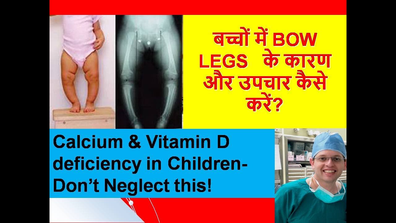 Symptoms of Calcium,Vitamin D Deficiency in Children|Bow Legs Treatment ...