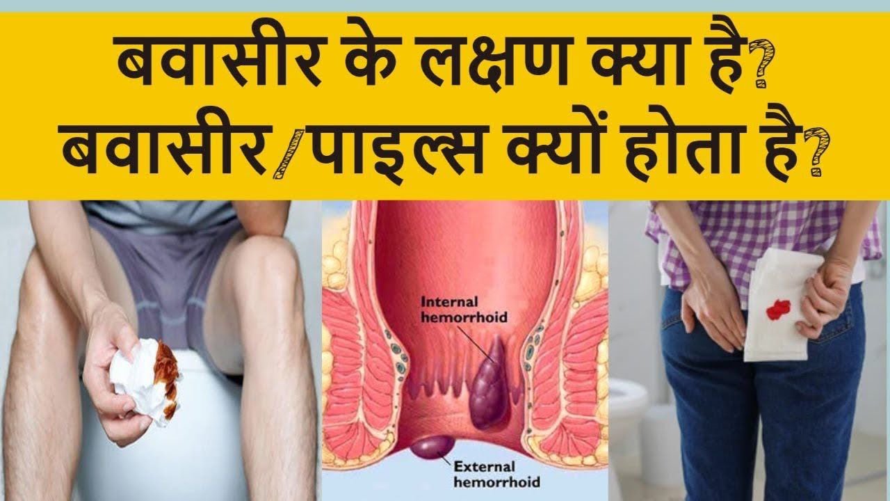 Bawasir Kay hota hai#doctor #mbbs #neet # ...