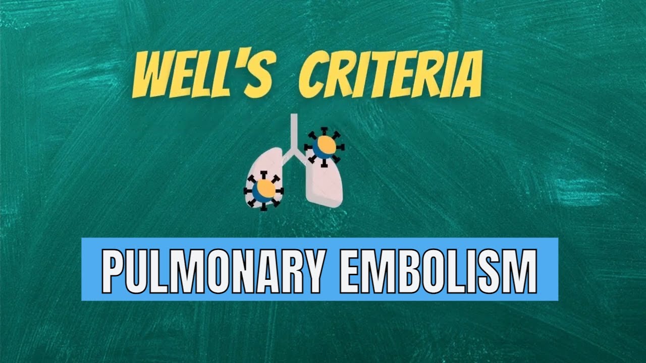 Wells criteria to rule out Pulmonary Embolism - YouTube