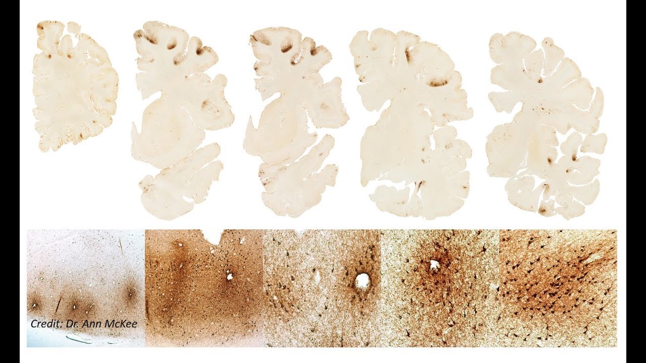 VA-BU-CLF Brain Bank Researchers find Stage III CTE in Aaron Hernandez ...