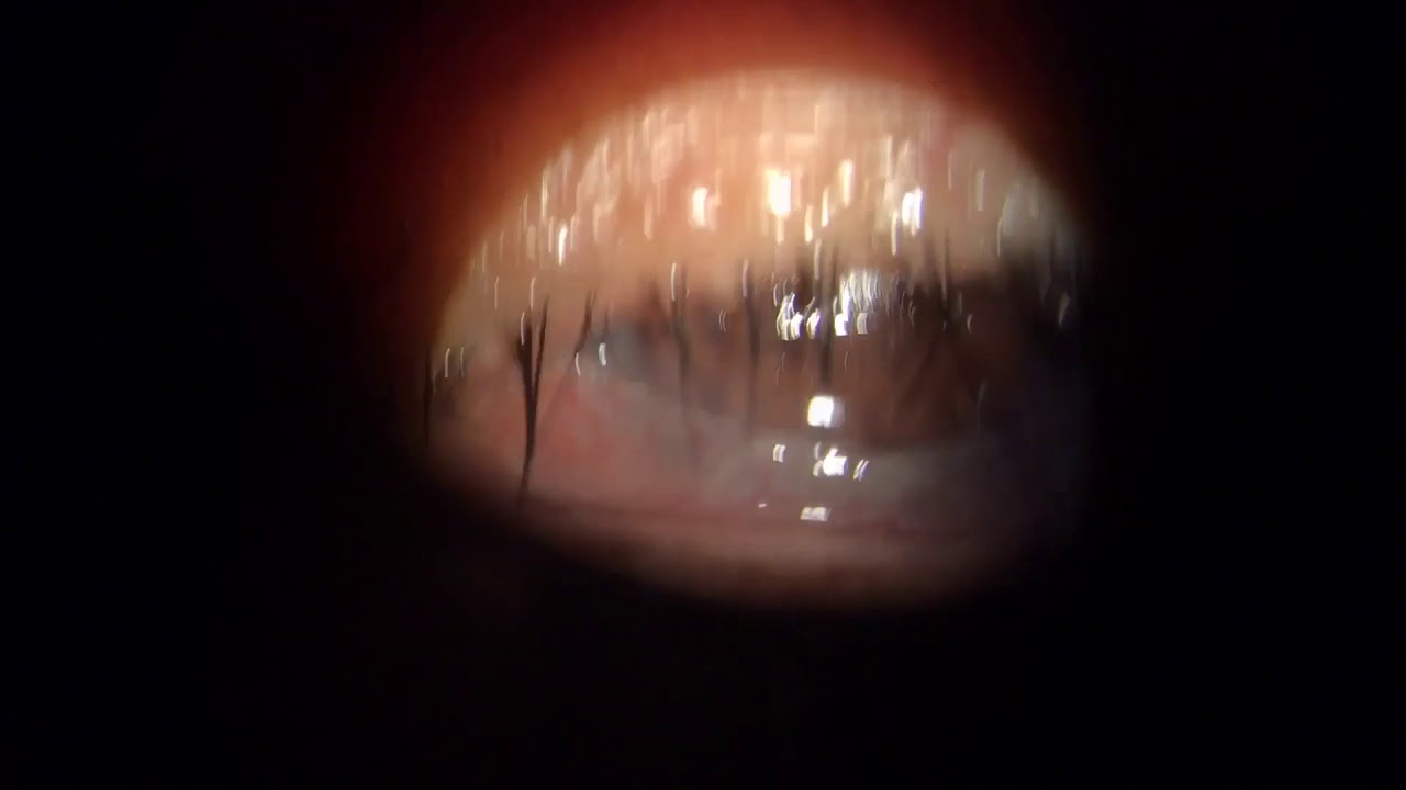 Conjunctivochalasis - YouTube