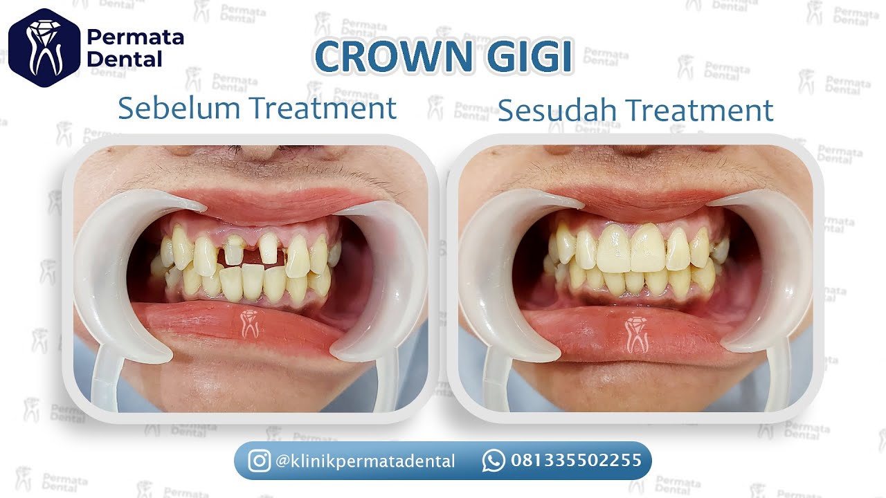 PROSES CROWN GIGI Memperbaiki Gigi Yang Bermasalah Jadi Bagus #25 ...