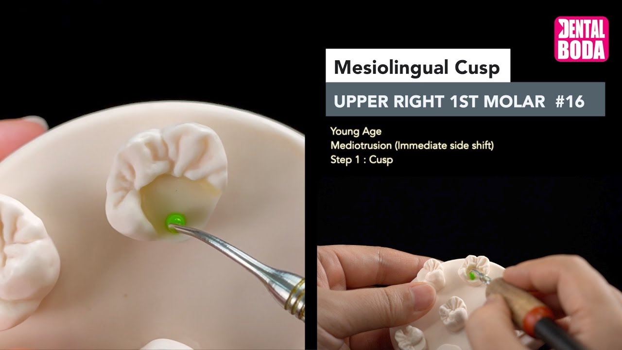 Upper Right 1st Molar mesiolingual cusp 1 cusp (young-aged) Wax-Up #16 ...