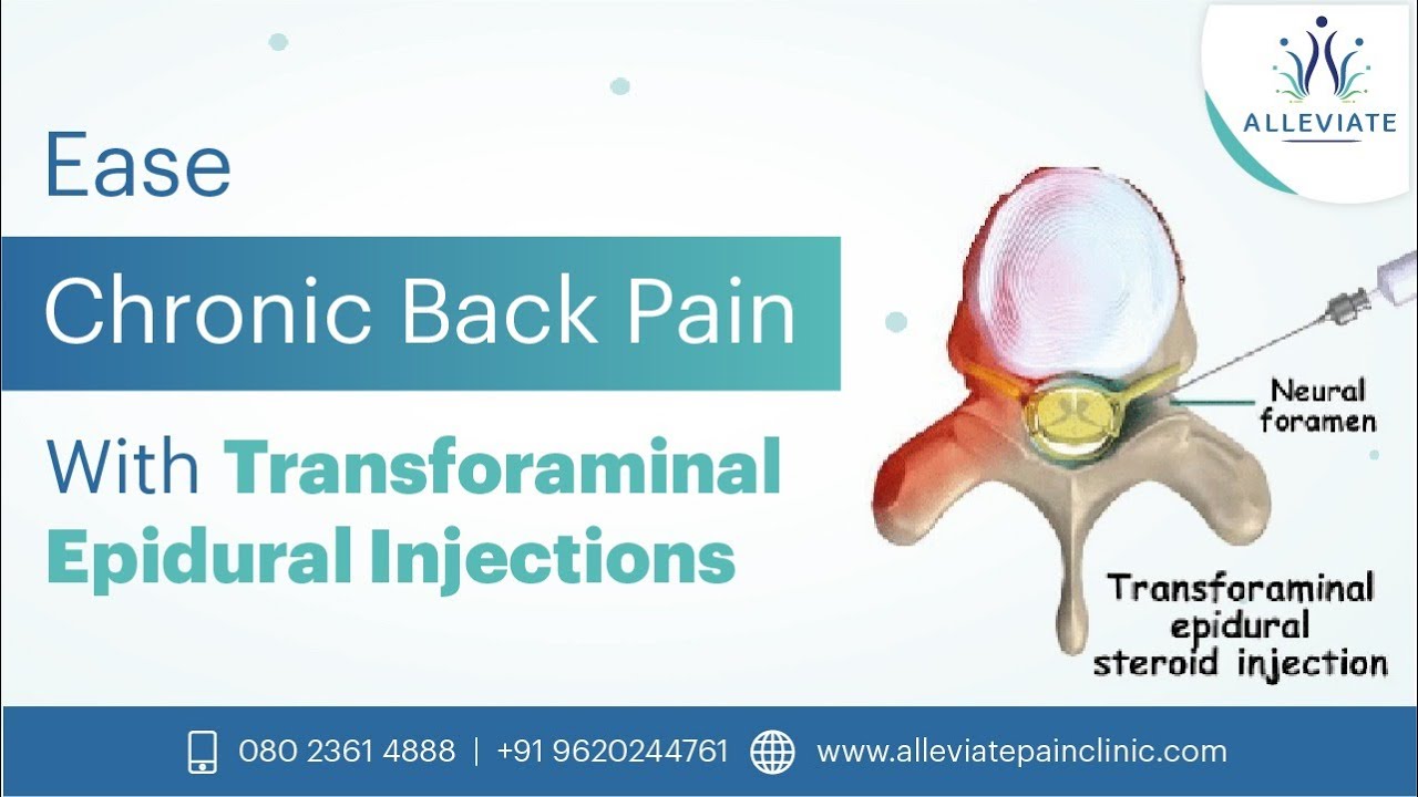 Say Goodbye to Back Pain: Transforaminal Epidural Injection Explained ...