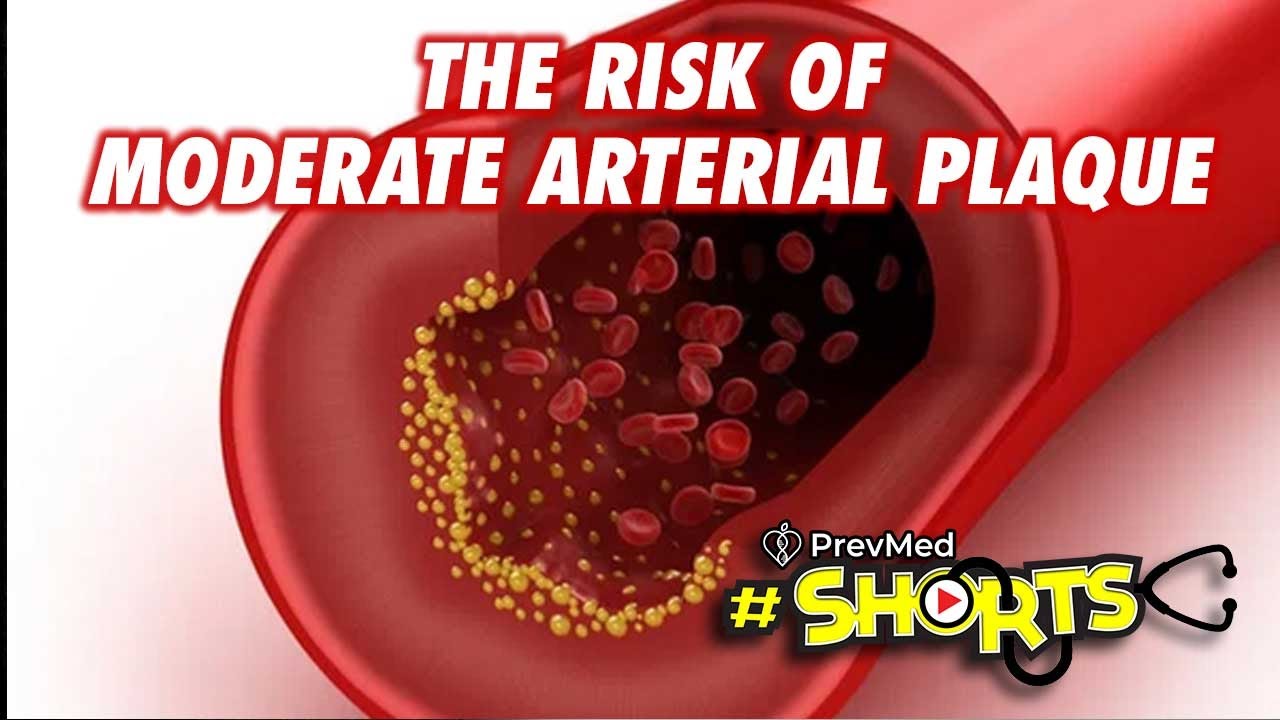 #SHORTS - THE RISK of Moderate Arterial Plaque - YouTube