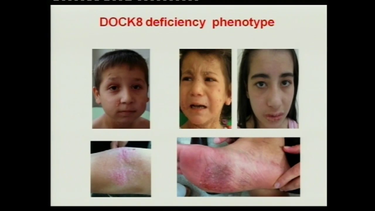 DOCK8 deficiency: Lessons in B-cell biology. By Prof. Raif Geha - YouTube