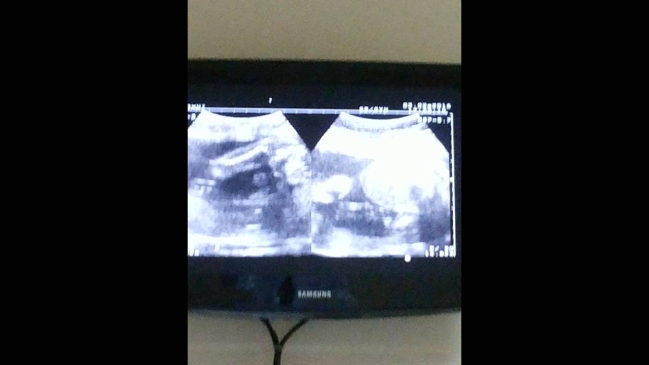 USG Kehamilan 5 bulan 24 minggu - YouTube