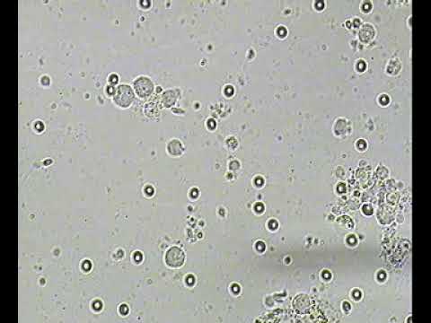 sperm found after Micro TESE - YouTube