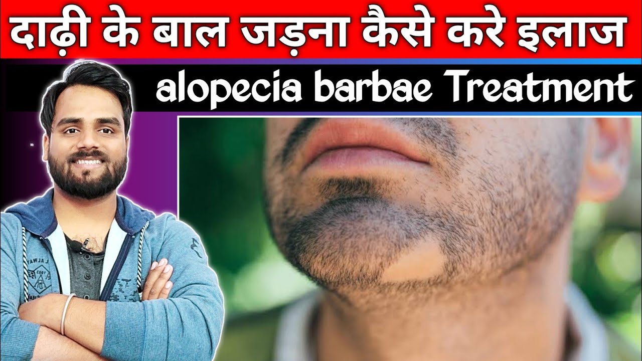 दाढ़ी के बाल झड़ना 😥 | alopecia barbae Causes Treatment | dadi ke baal ...