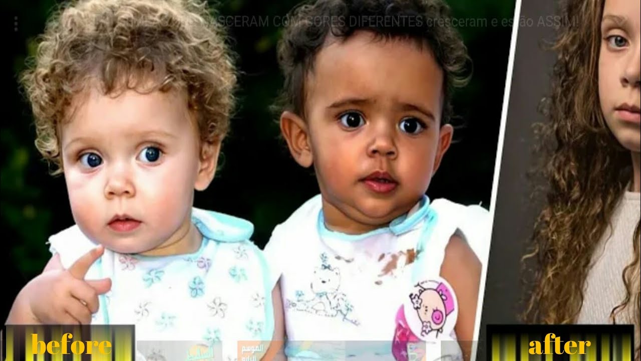 TWINS WHO WERE BORN WITH DIFFERENT COLORS have grown and are SO! - YouTube