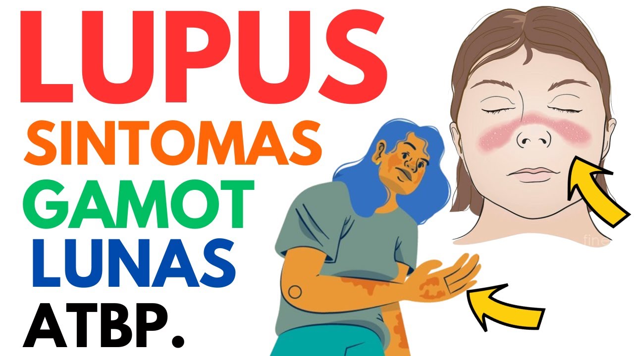 LUPUS - Mga SINTOMAS, Gamot at Lunas, Paano Nagkakaroon ng sakit na nito? | LUPOS - YouTube
