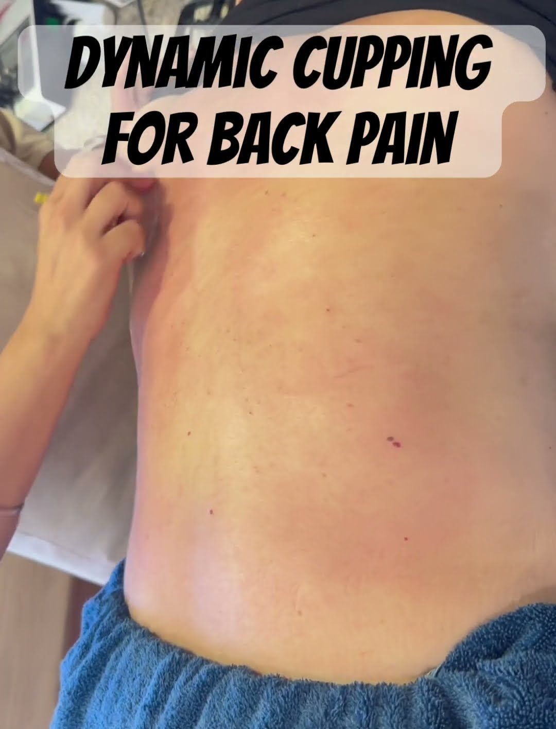 Dynamic Cupping For Back pain - YouTube