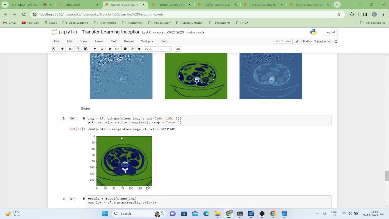 Kidney diseases detection and comparison using Saliency maps - YouTube
