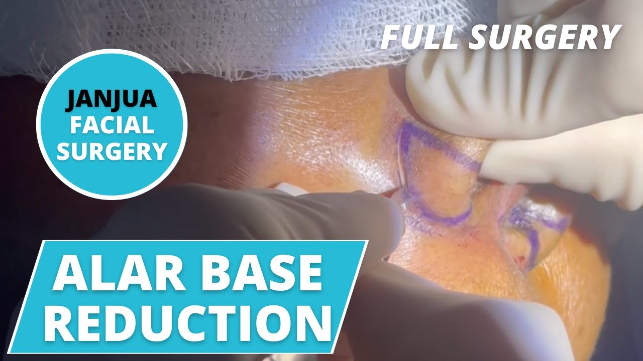 ALAR BASE REDUCTION LIVE SURGERY - DR. TANVEER JANJUA - NEW JERSEY ...