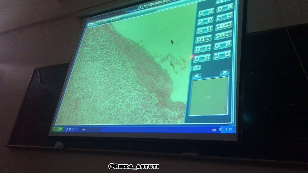 Gastric ulcer Histopathology || pathology lab || under microscope - YouTube