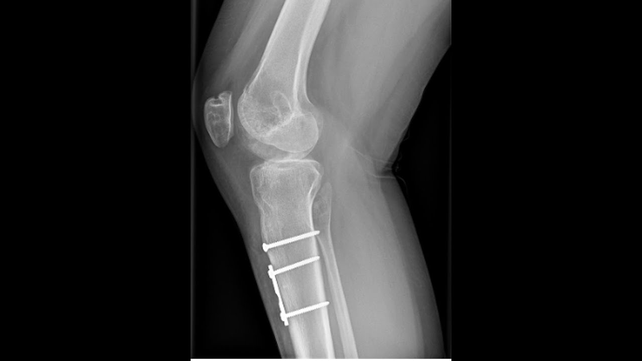 Tibial tuberosity distalisation with 1/3rd tubular plate fixation - YouTube