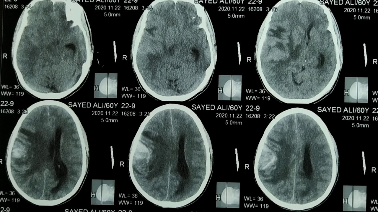Glioma on CT Scan of Brain - YouTube