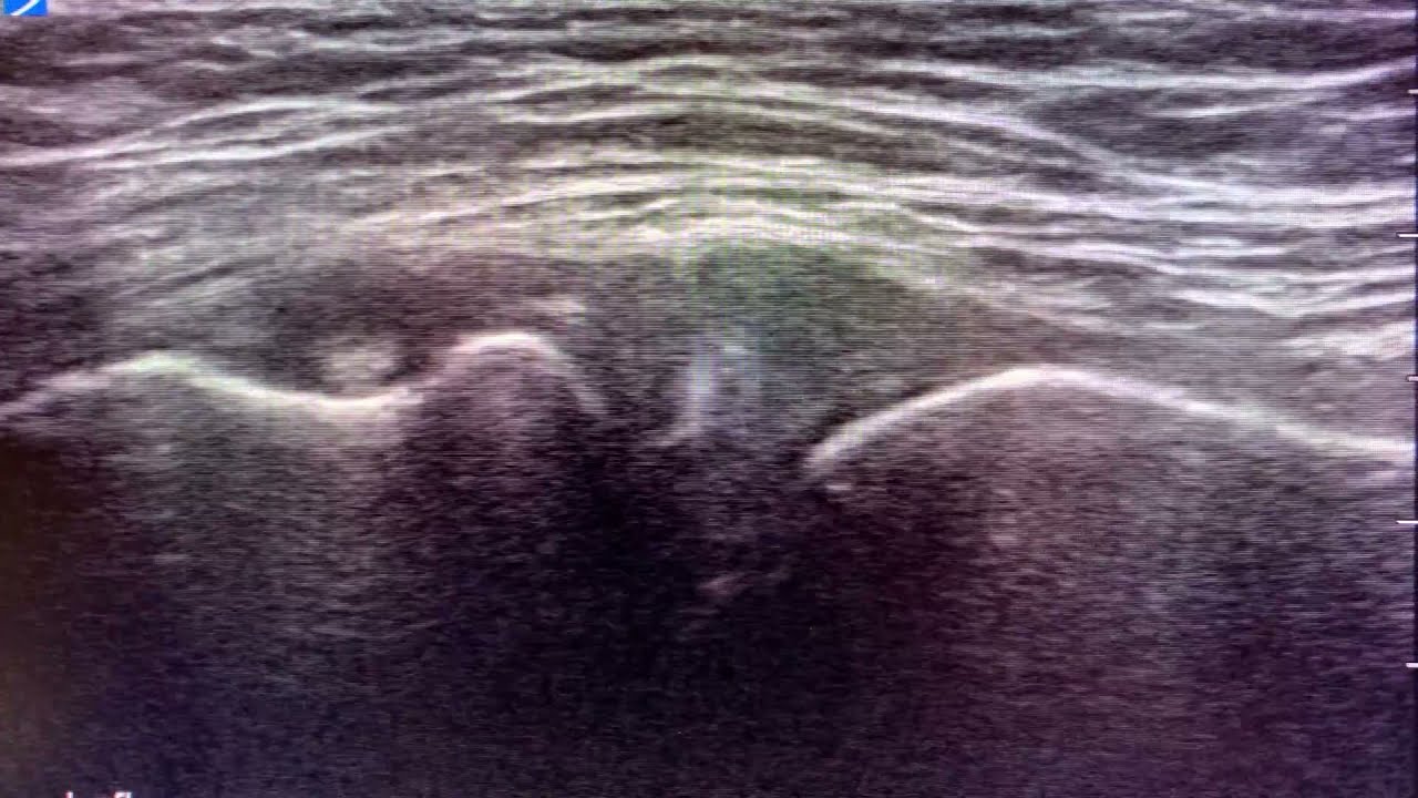 medial meniscus injection with MFAT PRP video using ultrasound guidance ...