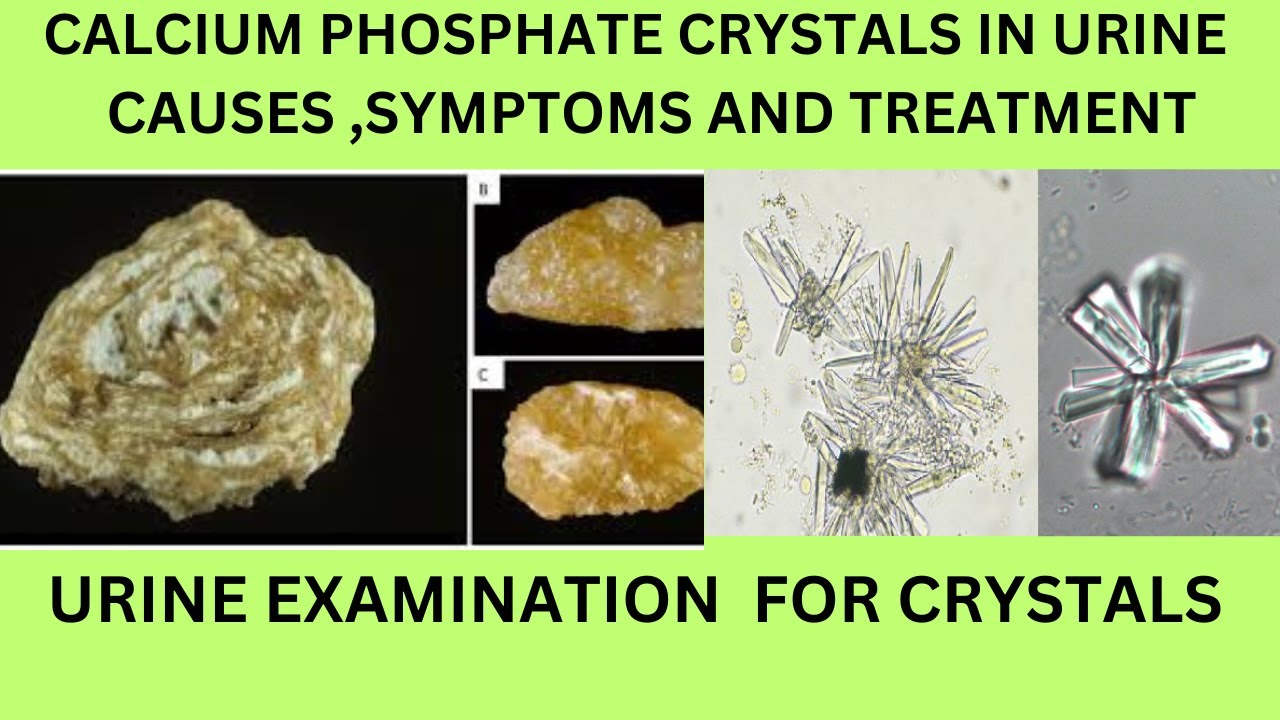 CALCIUM PHOSPHATE CRYSTALS IN URINE.CAUSES ,SYMPTOMS TREATMENT OF CALCIUM PHOSPHATE STONES - YouTube