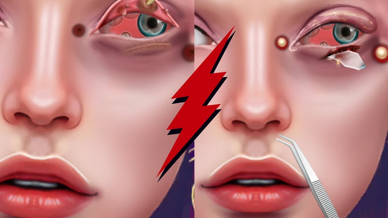 The Satisfaction You've Been Waiting For: ASMR Pimple Popping Makeup ...