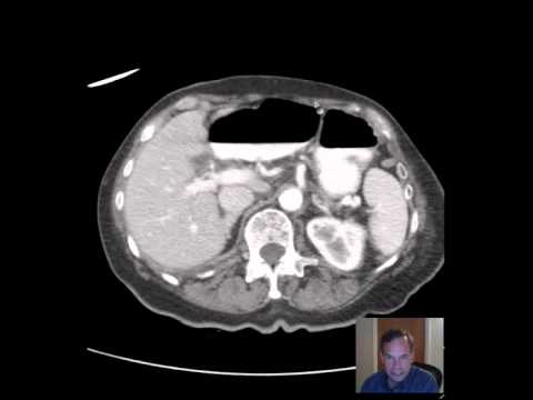 CT Colon CA Discussion - YouTube
