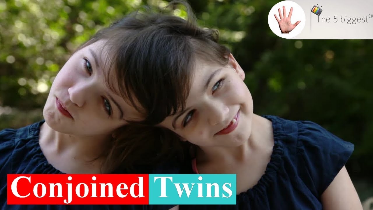 Conjoined Twins: Top 10 Facts You 🅳🅾🅽'🆃 Need to Know! ~ Body Bizarre ...