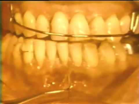 The Laterally Positioned Flap in Periodontics - YouTube