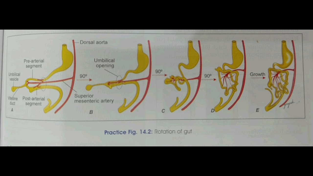 Mid gut rotation - YouTube
