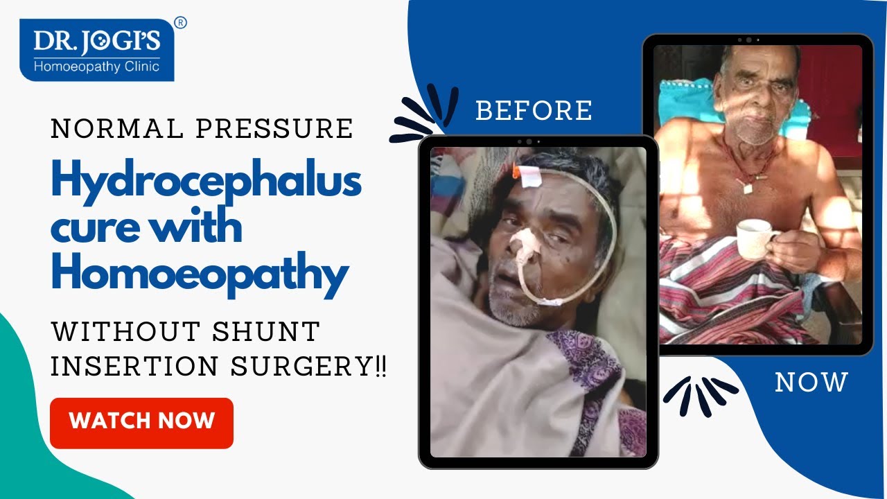 Normal pressure Hydrocephalus cure with Homoeopathy without shunt ...