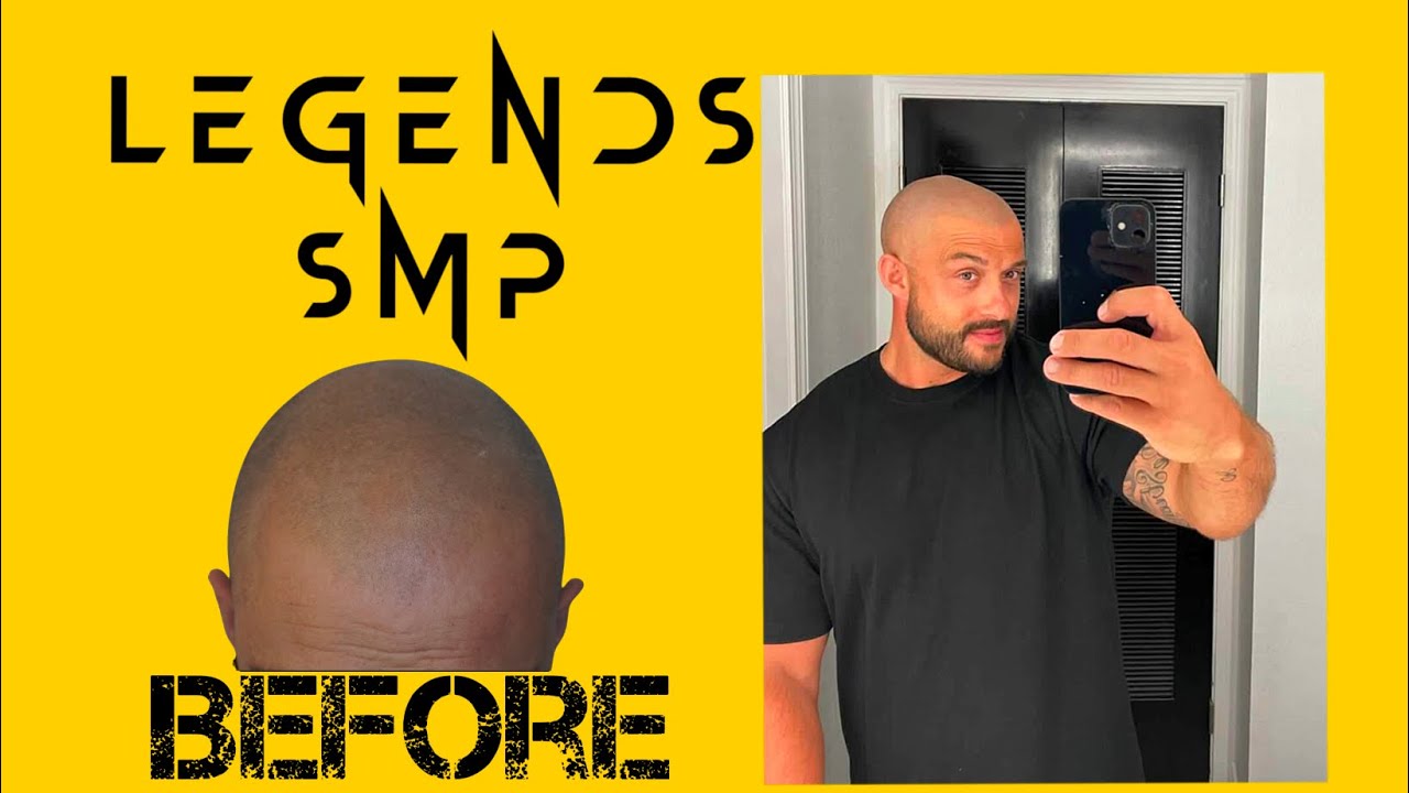 How scalp micropigmentation ( SMP ) changed my life - YouTube