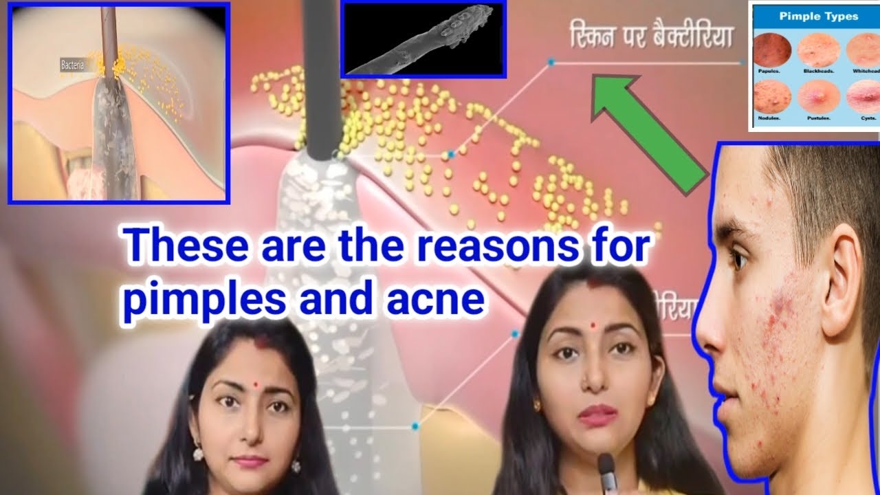 Pimple Acne Caused by Face Mites and Bacteria🧐 क्या आपको पता है फेस ...